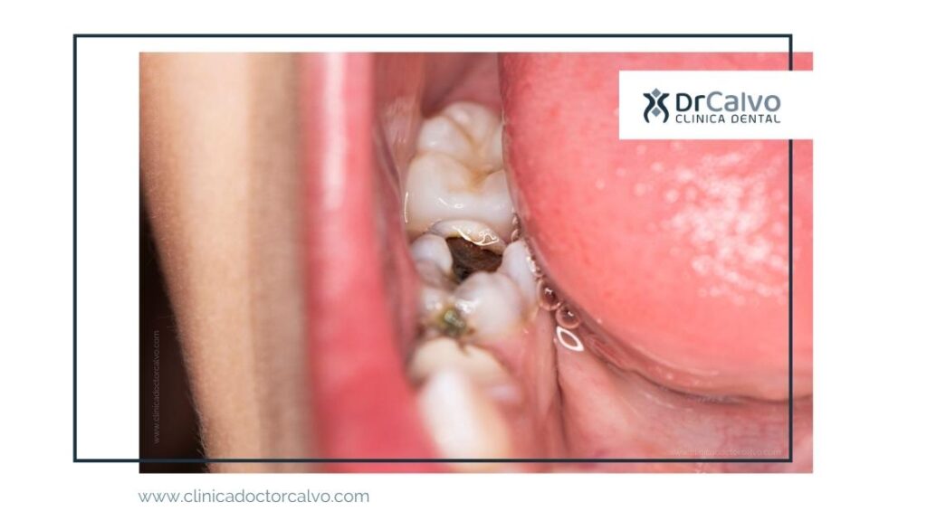 Caries: causas, tipos y tratamientos | Clínica Doctor Calvo Sevilla