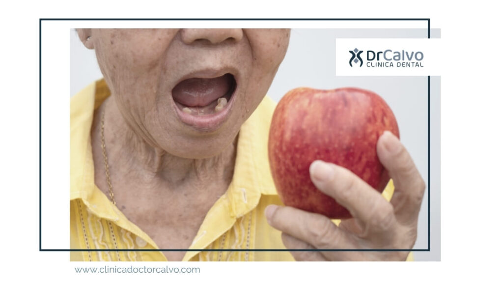 Caída de dientes: Cómo tratar el edentulismo | Clínica Doctor Calvo Sevilla